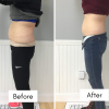 Trusculpt Id Body Sculpting Bangor Me Penobscot Medical Aesthetics