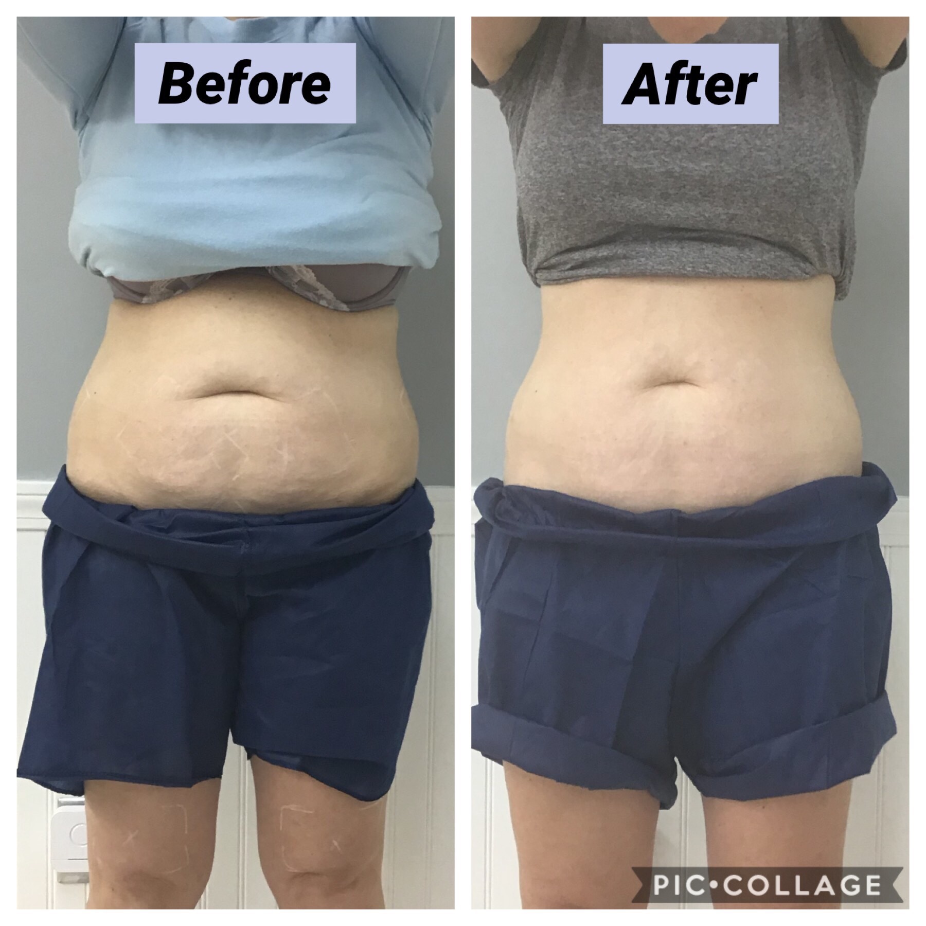 Trusculpt Id Body Sculpting Bangor Me Penobscot Medical Aesthetics